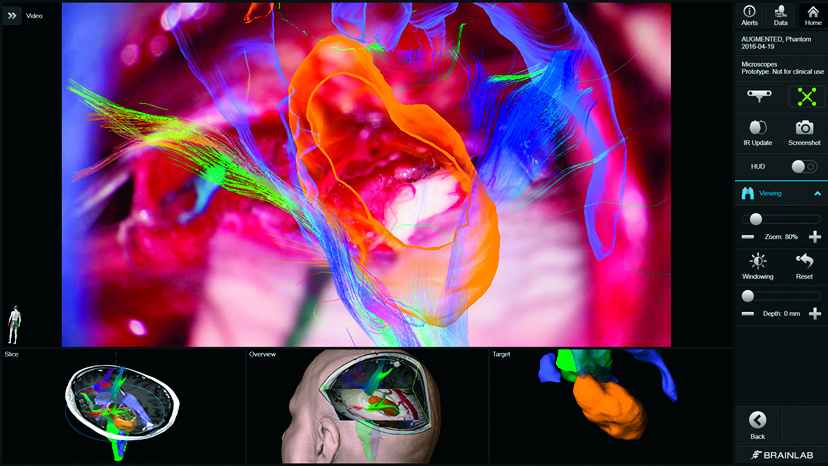 Medizintechnik: Mit Augmented Reality gegen den Brainshift – Elektronik ...